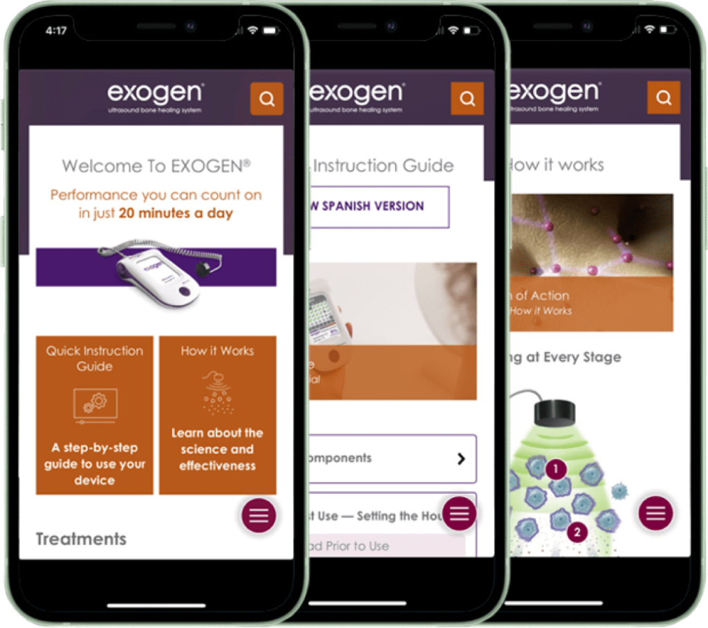 Staying Connected | EXOGEN Ultrasound Bone Healing System