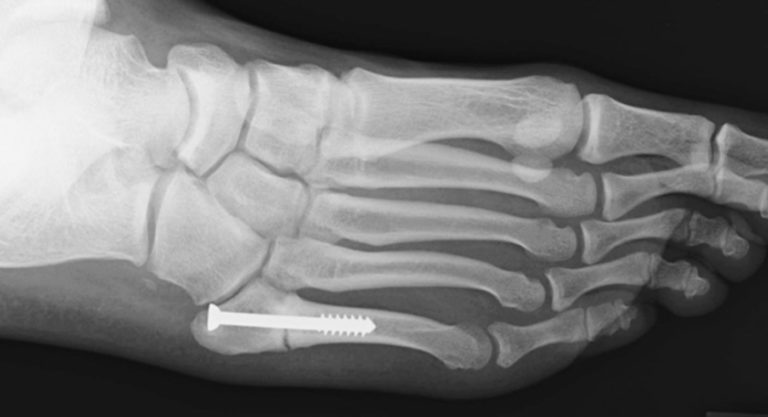 Patient Case Studies | EXOGEN Ultrasound Bone Healing System