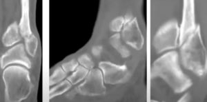 Physician Resources Archive | EXOGEN Ultrasound Bone Healing System